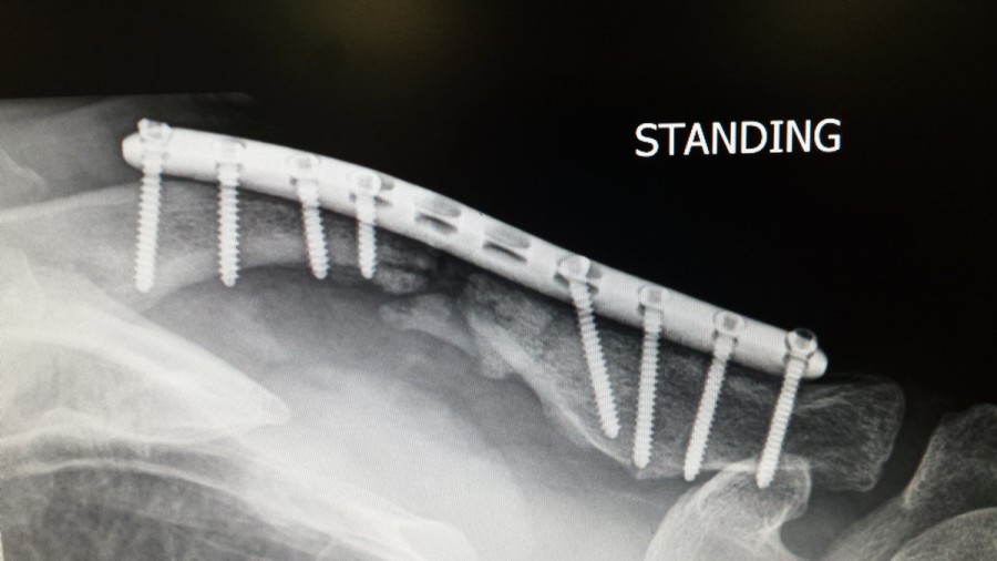 5 Key Tips to Reducing Recovery Times After Breaking a Bone ...