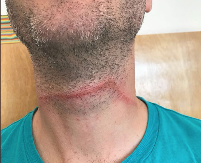 Suspected Trap On South African Trail Injures Mountain Biker ...